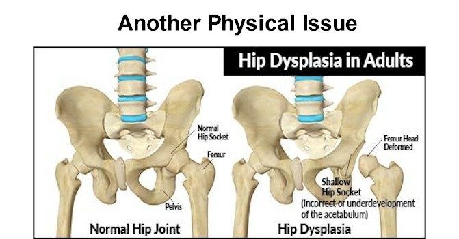 Left Hip Issue | The Journey of Joshua Adam Dover